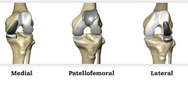 Partial Knee Replacement – Dr. Barry Cayen | Toronto Orthopaedic Surgeon